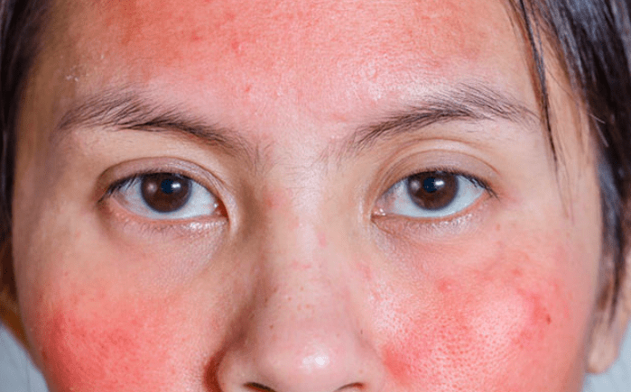 Causes of Redness of Face - Learn about Common Triggers - Rajasthan ...